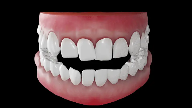 Invisalign: For More than Just a Beautiful Smile - Williams Square Dental